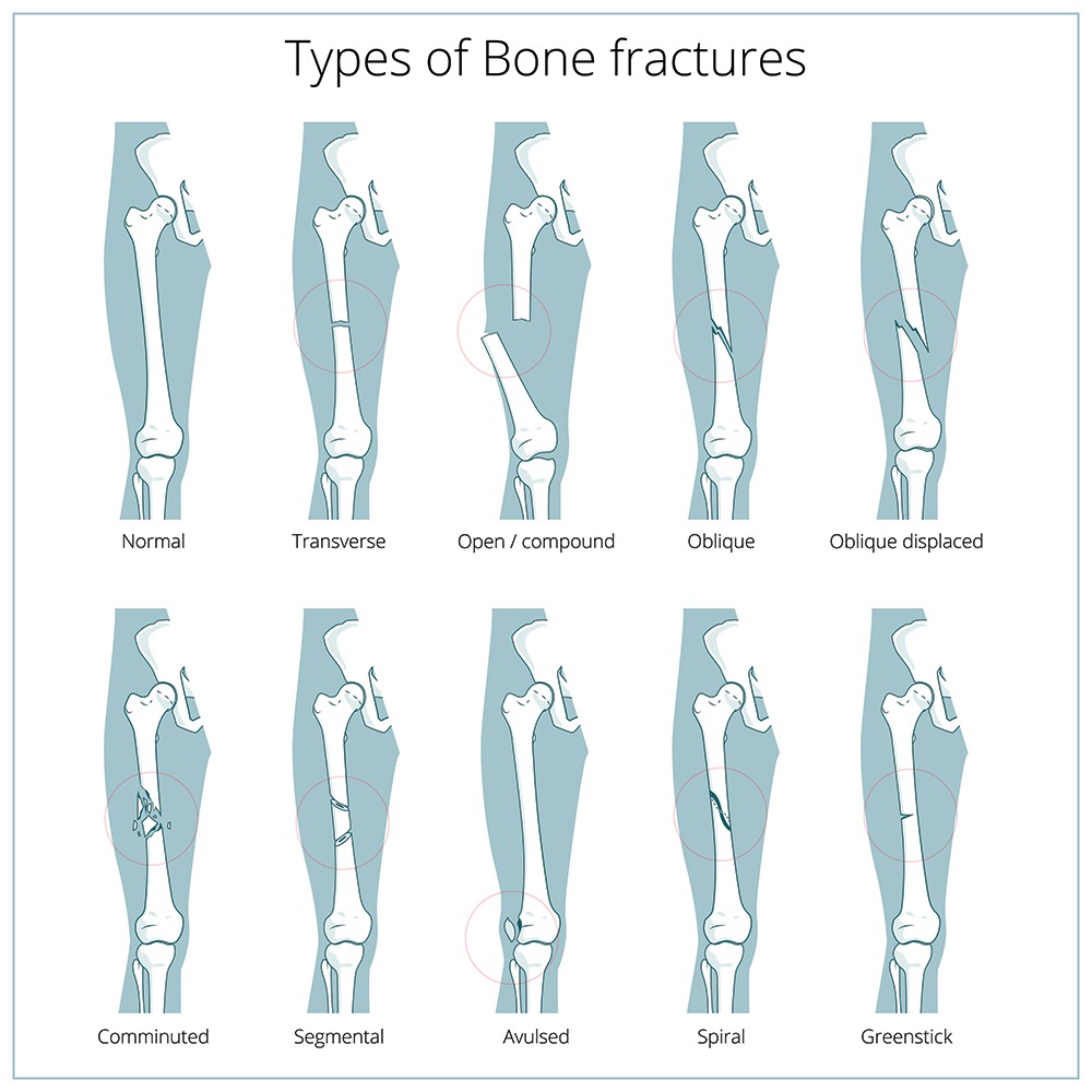 Compound Fracture After Car Accident The Vrana Law Firm Personal Compound Fracture After Car Accident The Vrana Law Firm Personal
